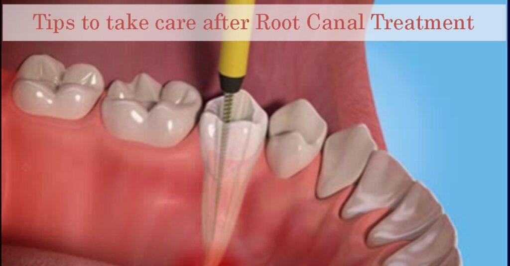 TIPS TO CARE AFTER A ROOT CANAL TREATMENT TIPS TO CARE AFTER A ROOT CANAL TREATMENT